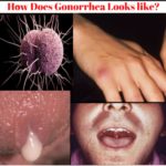 What is Blue Wafflé Disease (Pictured) - Public Health