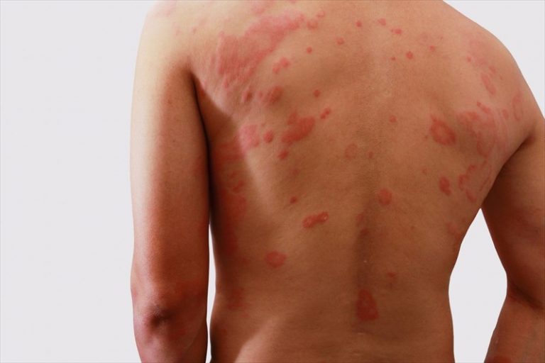 How long does a Tramadol Rash Last - Public Health