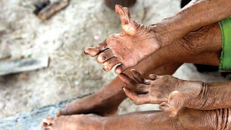 What is leprosy? - Public Health