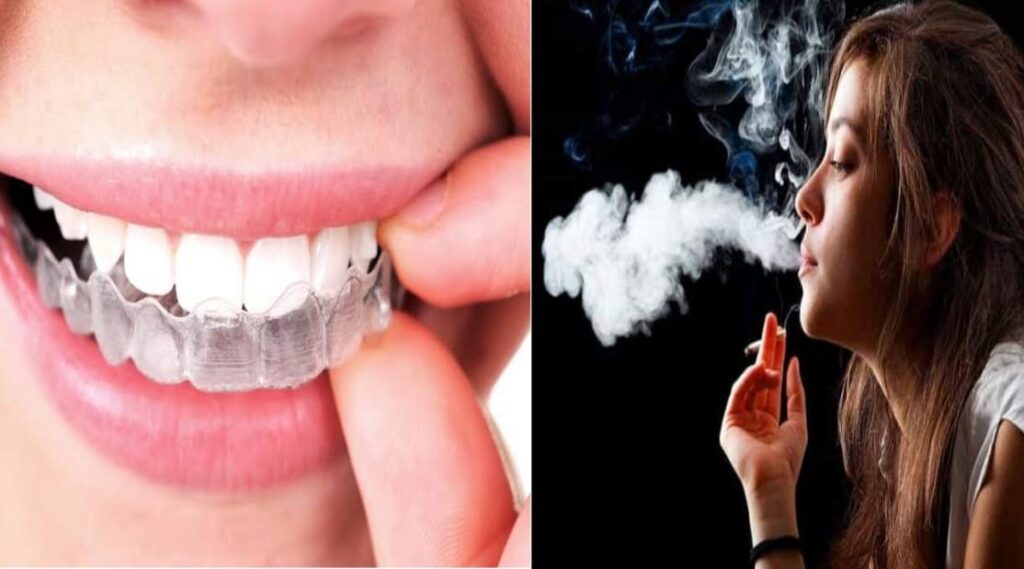Can You Smoke With Invisalign? - Public Health
