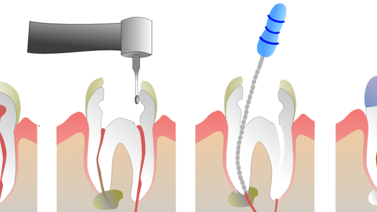 How To Prevent Root Canal Procedure – Public Health