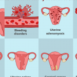 How To Clean Uterus After A Miscarriage Naturally - Public Health