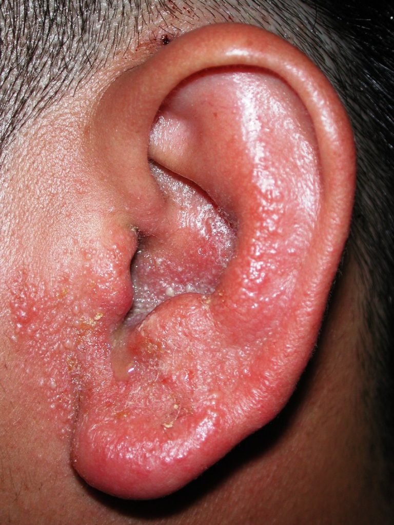 Can Allergies Cause Recurring Ear Infections? - Public Health