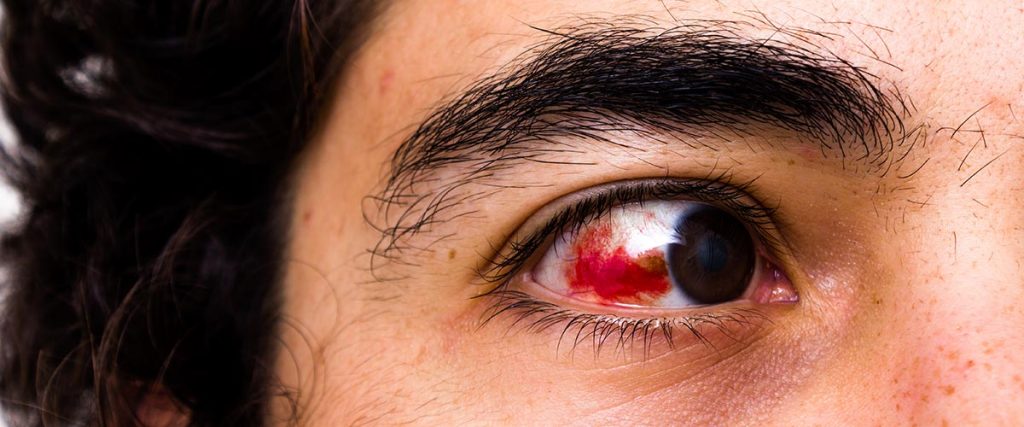 How to Sleep With A Scratched Eye - Public Health