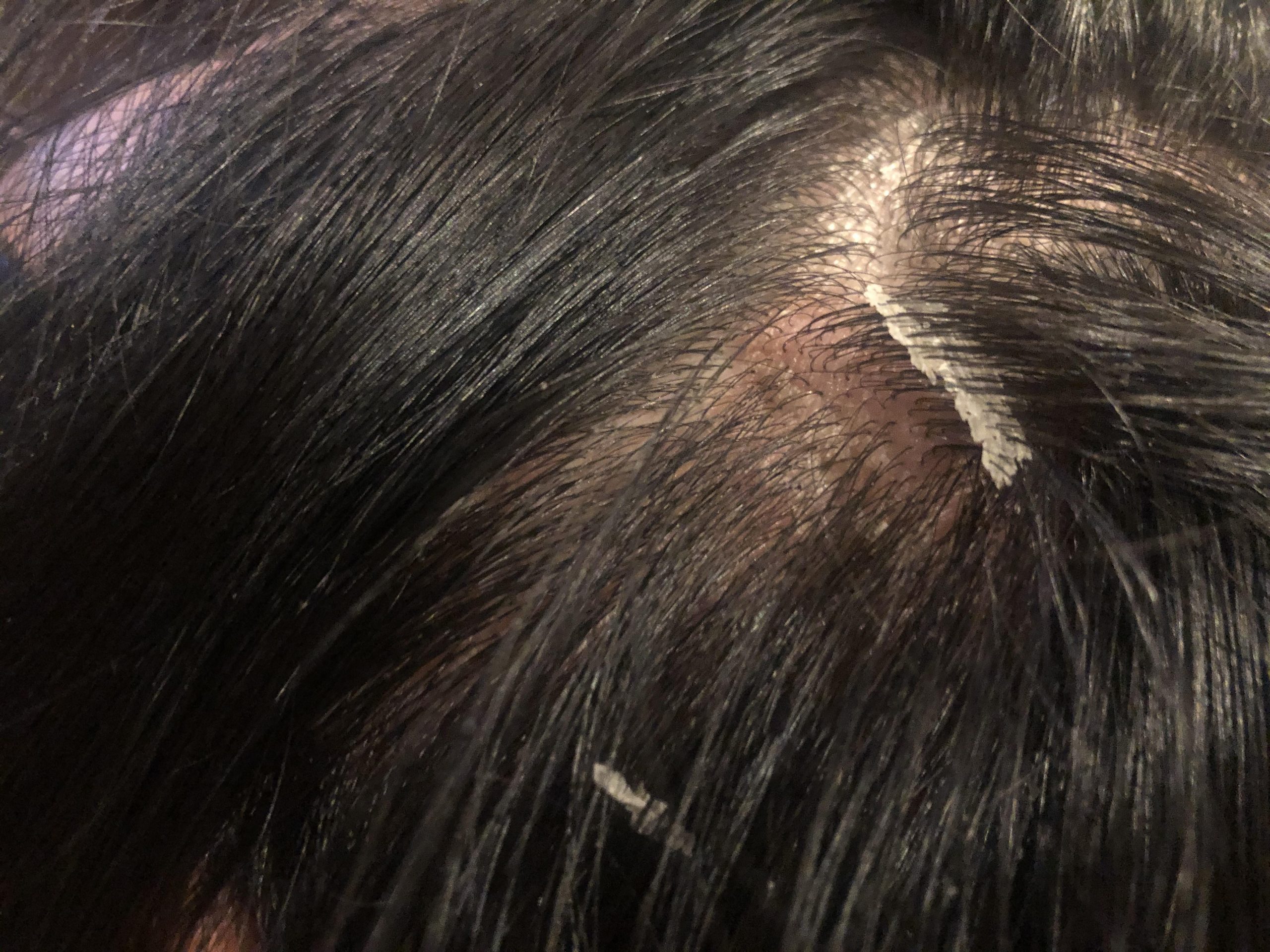 What s The Biggest Dandruff Flake Ever Public Health What s The Biggest Dandruff Flake Ever Public Health
