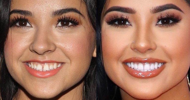 How Wide Is The Gap Between Becky G Teeth - Public Health