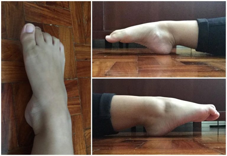 What Is Sickled Feet? Causes, Symptoms, Treatment, Prevention - Public ...