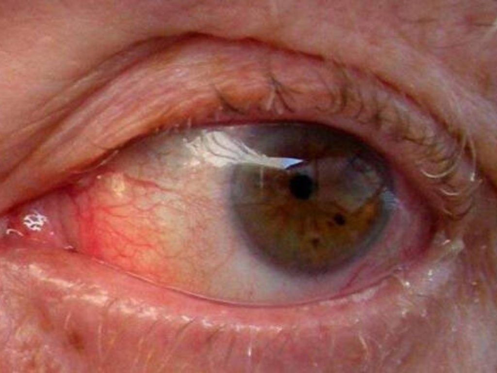 Glaucoma: A Hidden Threat to Vision Health Rising Swiftly - Public Health